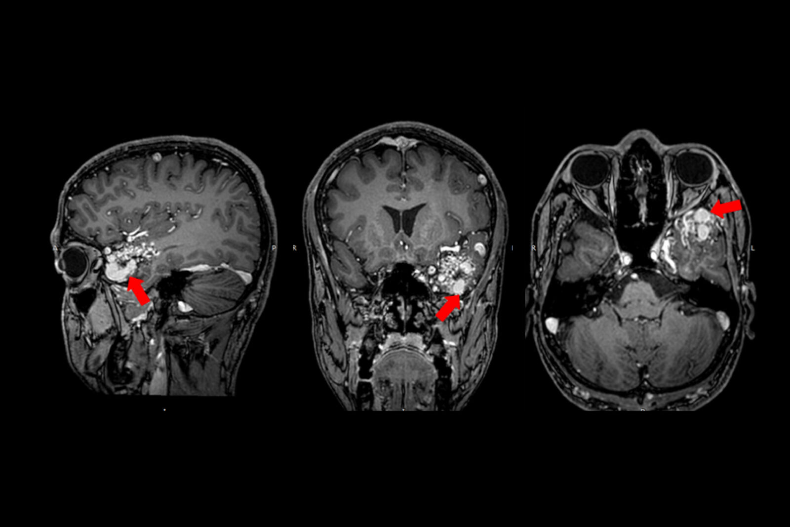 GLOW800 增强现实荧光在动静脉畸形（AVM）治疗中的应用 | 学习与分享 | 徕卡显微系统