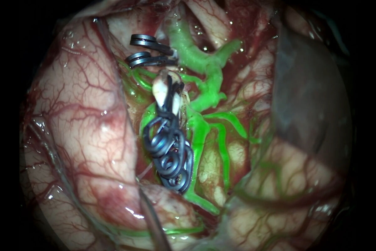 GLOW800增强现实荧光技术在动脉瘤治疗中的应用 | 学习与分享 | 徕卡显微系统