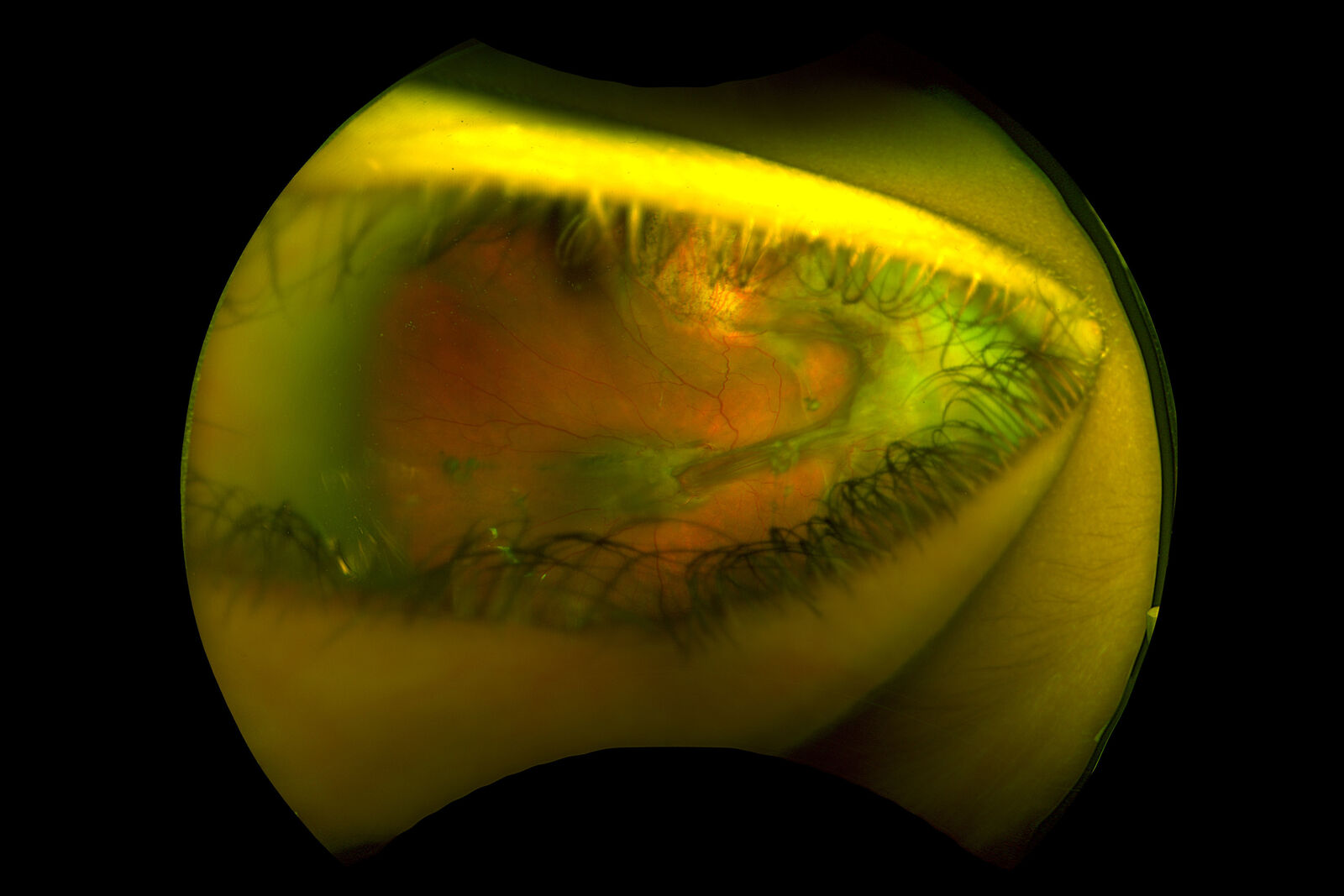术中光学相干断层扫描（OCT）辅助下增生性玻璃体视网膜病变的手术治疗 | 学习与分享 | 徕卡显微系统