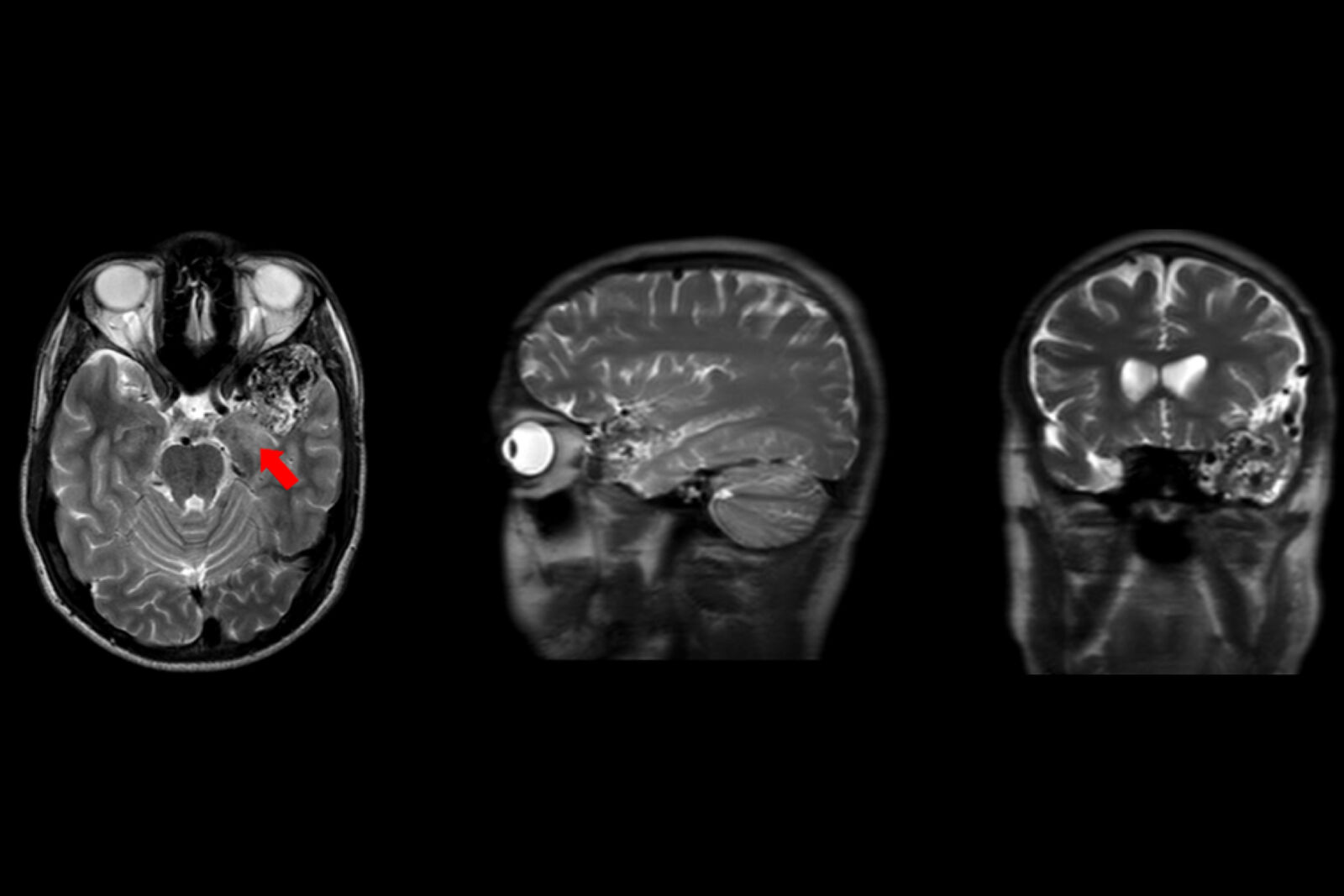 GLOW800 增强现实荧光在动静脉畸形（AVM）治疗中的应用 | 学习与分享 | 徕卡显微系统
