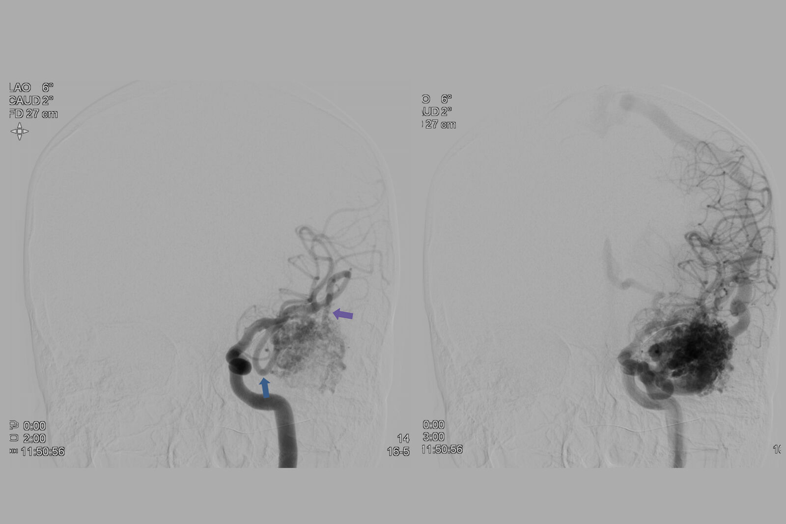GLOW800 增强现实荧光在动静脉畸形（AVM）治疗中的应用 | 学习与分享 | 徕卡显微系统