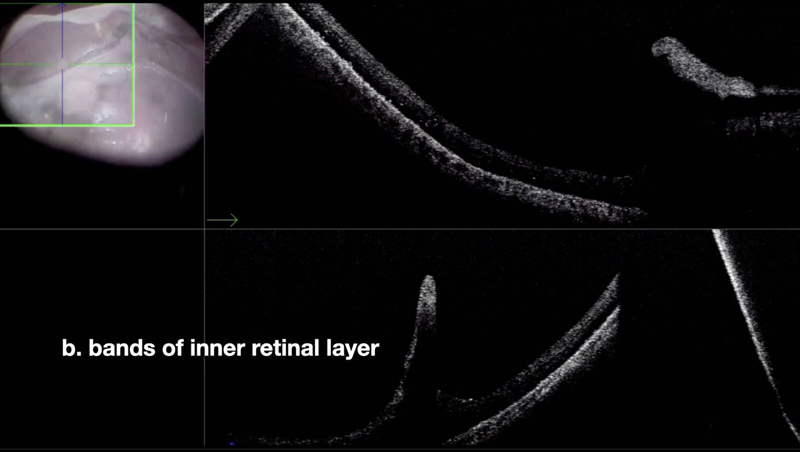 眼科手术向常规使用术中OCT的阶段迈进 | 学习与分享 | 徕卡显微系统