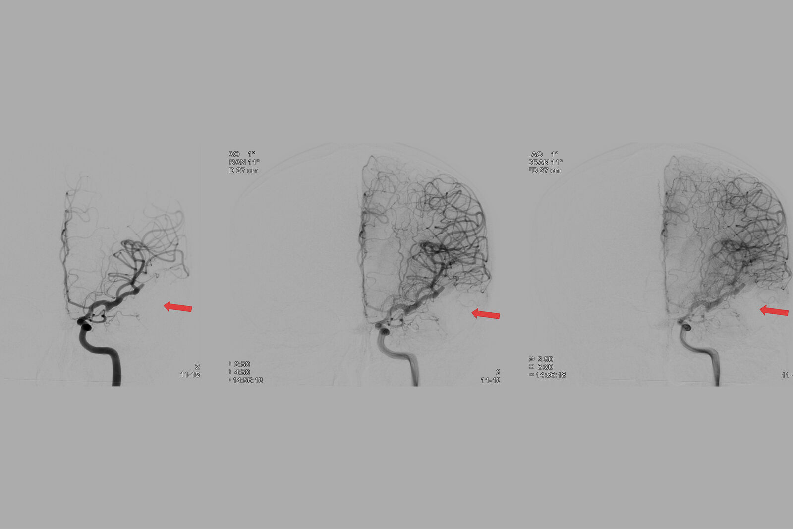 GLOW800 增强现实荧光在动静脉畸形（AVM）治疗中的应用 | 学习与分享 | 徕卡显微系统