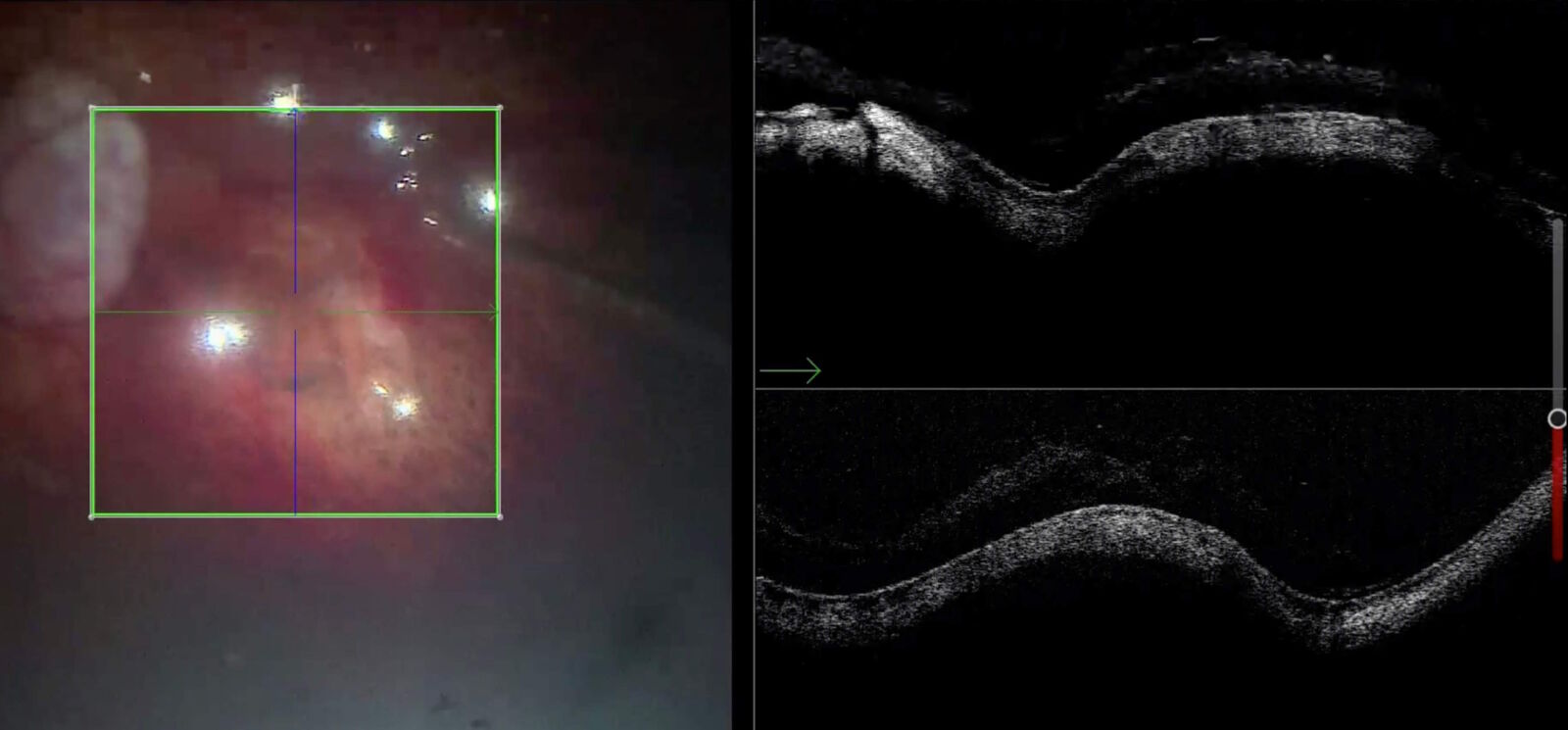 眼科手术向常规使用术中OCT的阶段迈进 | 学习与分享 | 徕卡显微系统